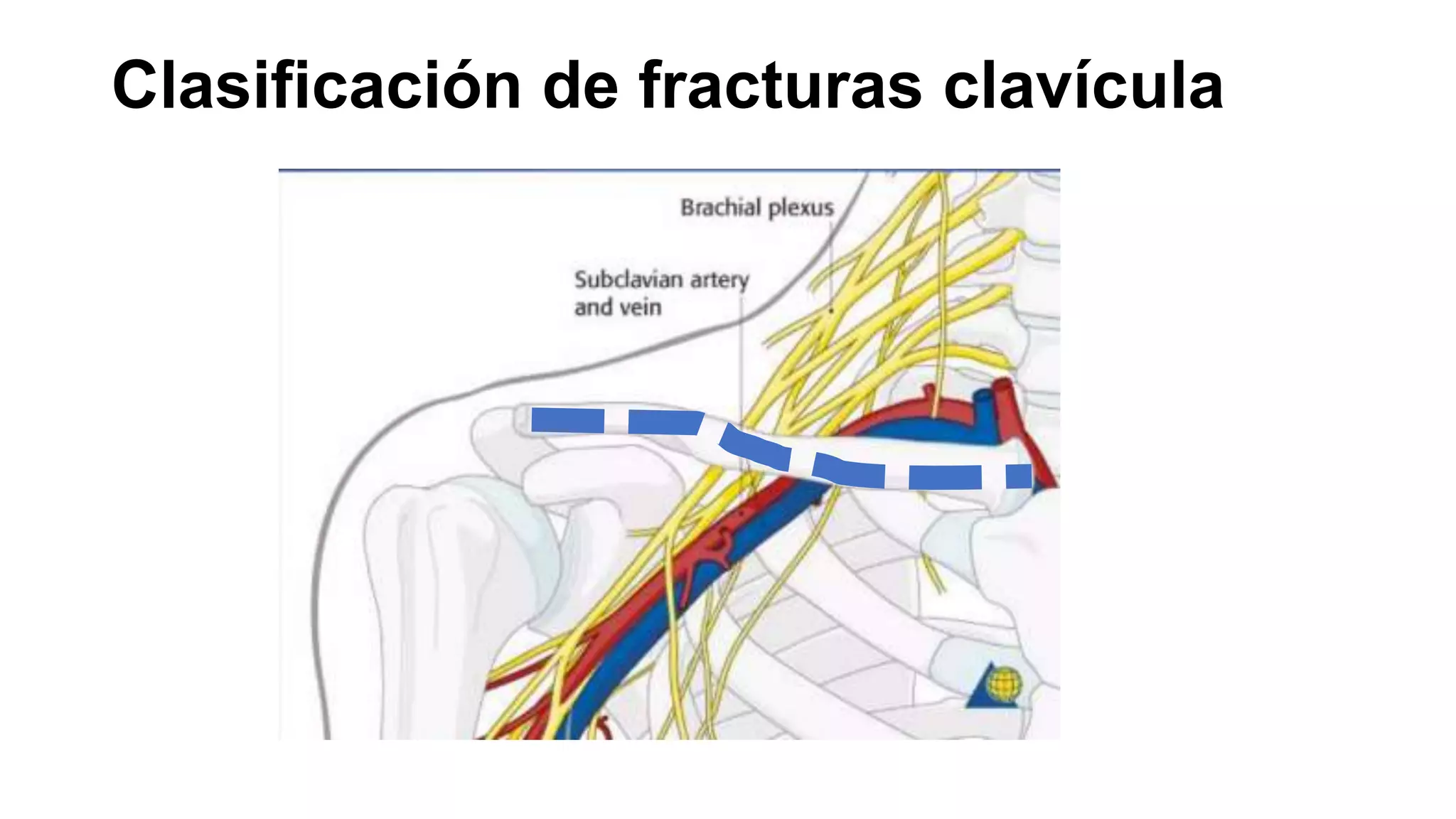Clasificación de fracturas clavícula | PPTX