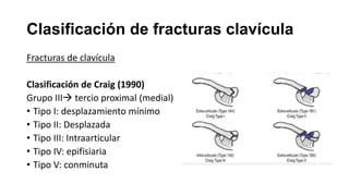 Clasificación de fracturas clavícula | PPTX