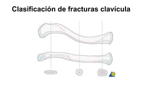 Clasificación de fracturas clavícula | PPTX