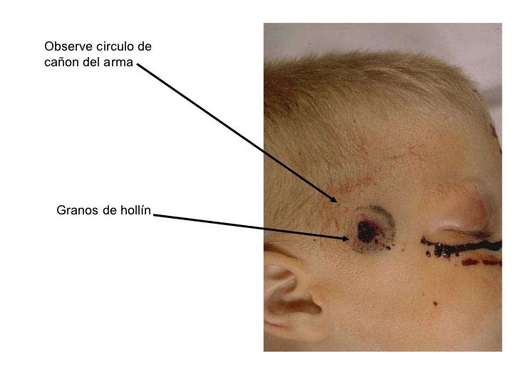 Clasificación De Heridas Por Impacto De Bala Dr Javier Mata Vargas