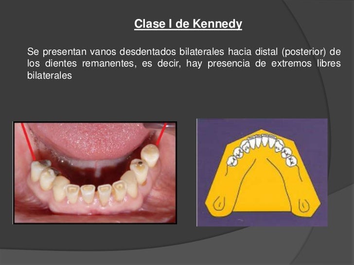 Clasificación de kennedy