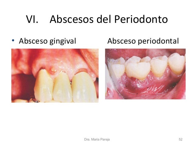 Clasificaciòn de las enfermedades periodontales