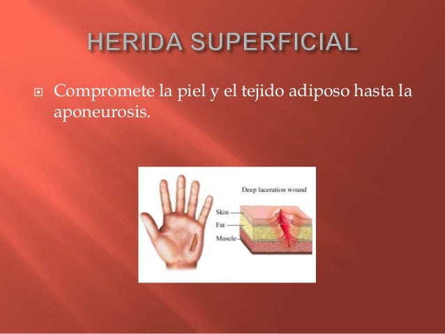 Clasificación de las heridas según su profundidad