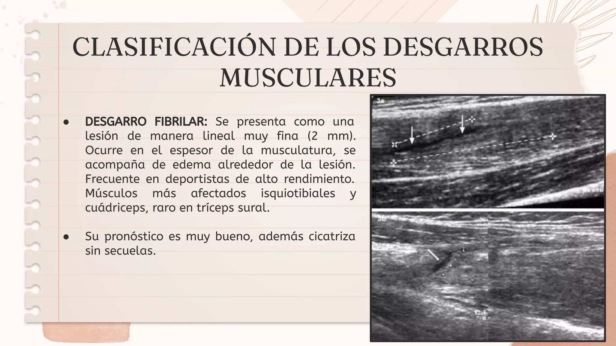 Clasificación de los desagarros musculares.pdf