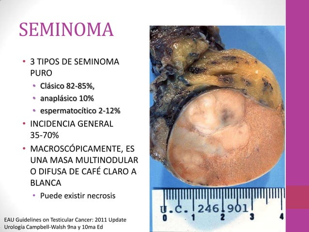 Clasificación histológica de tumores de células germinales