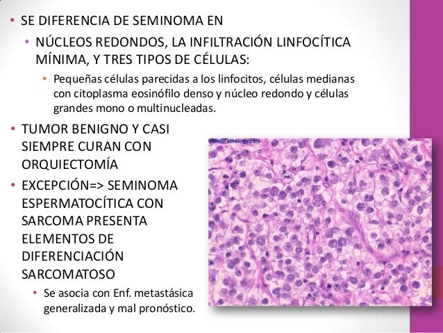 Clasificación histológica de tumores de células germinales