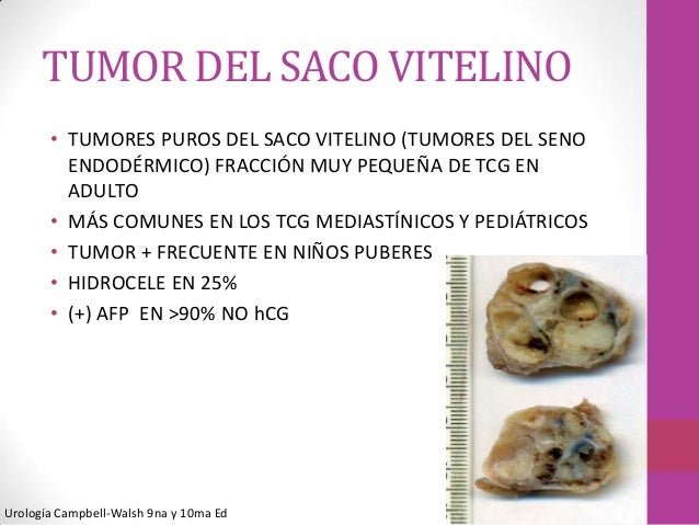 Clasificación histológica de tumores de células germinales