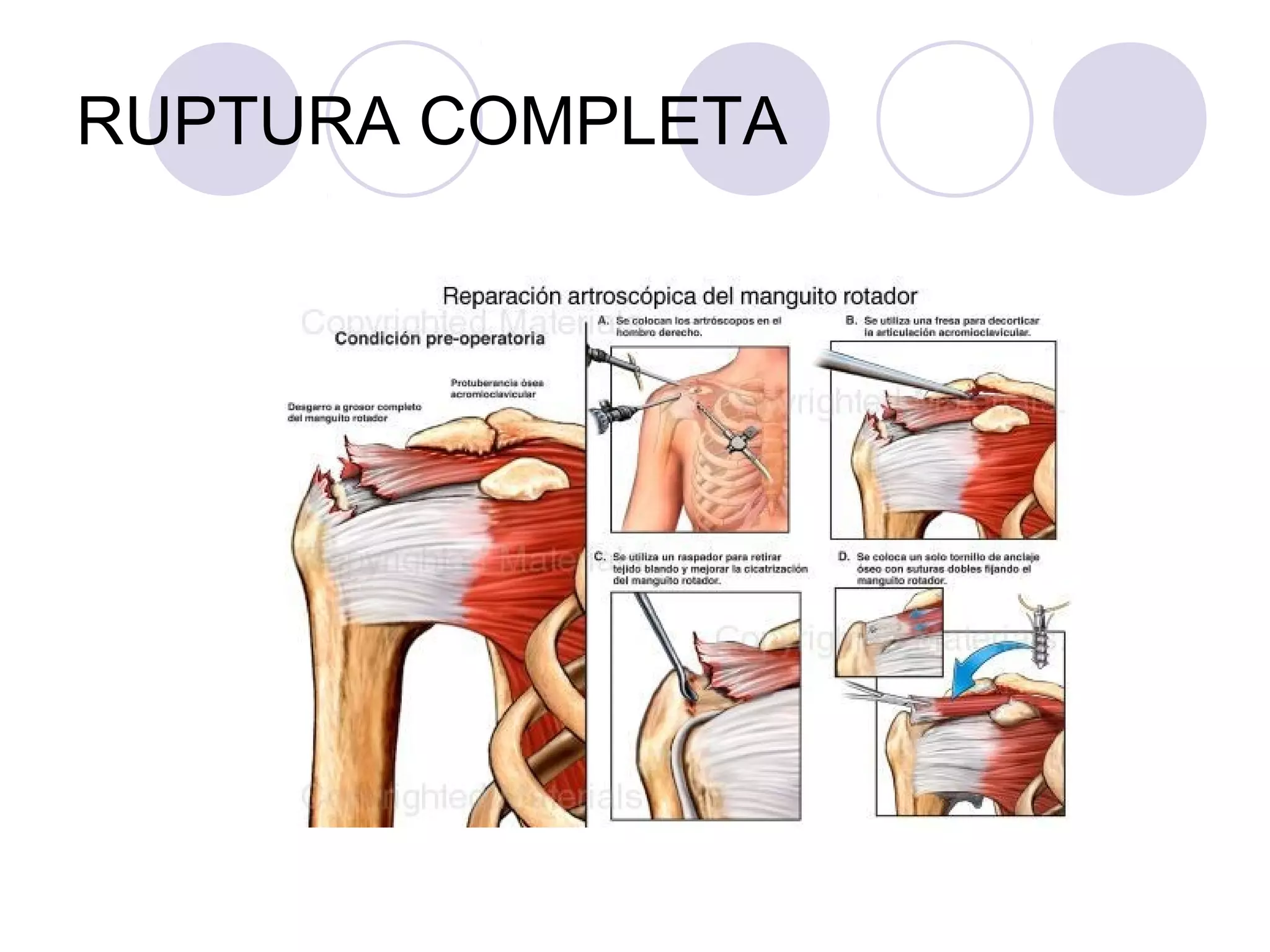 Sindrome de dolor Subacromial. Manguito Rotador. Tendinopatía | PPT