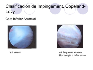 Sindrome de dolor Subacromial. Manguito Rotador. Tendinopatía | PPT