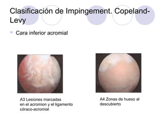Sindrome de dolor Subacromial. Manguito Rotador. Tendinopatía | PPT