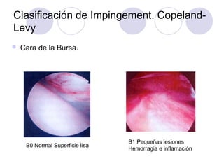 Sindrome de dolor Subacromial. Manguito Rotador. Tendinopatía | PPT