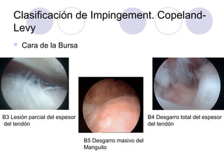 Sindrome de dolor Subacromial. Manguito Rotador. Tendinopatía | PPT