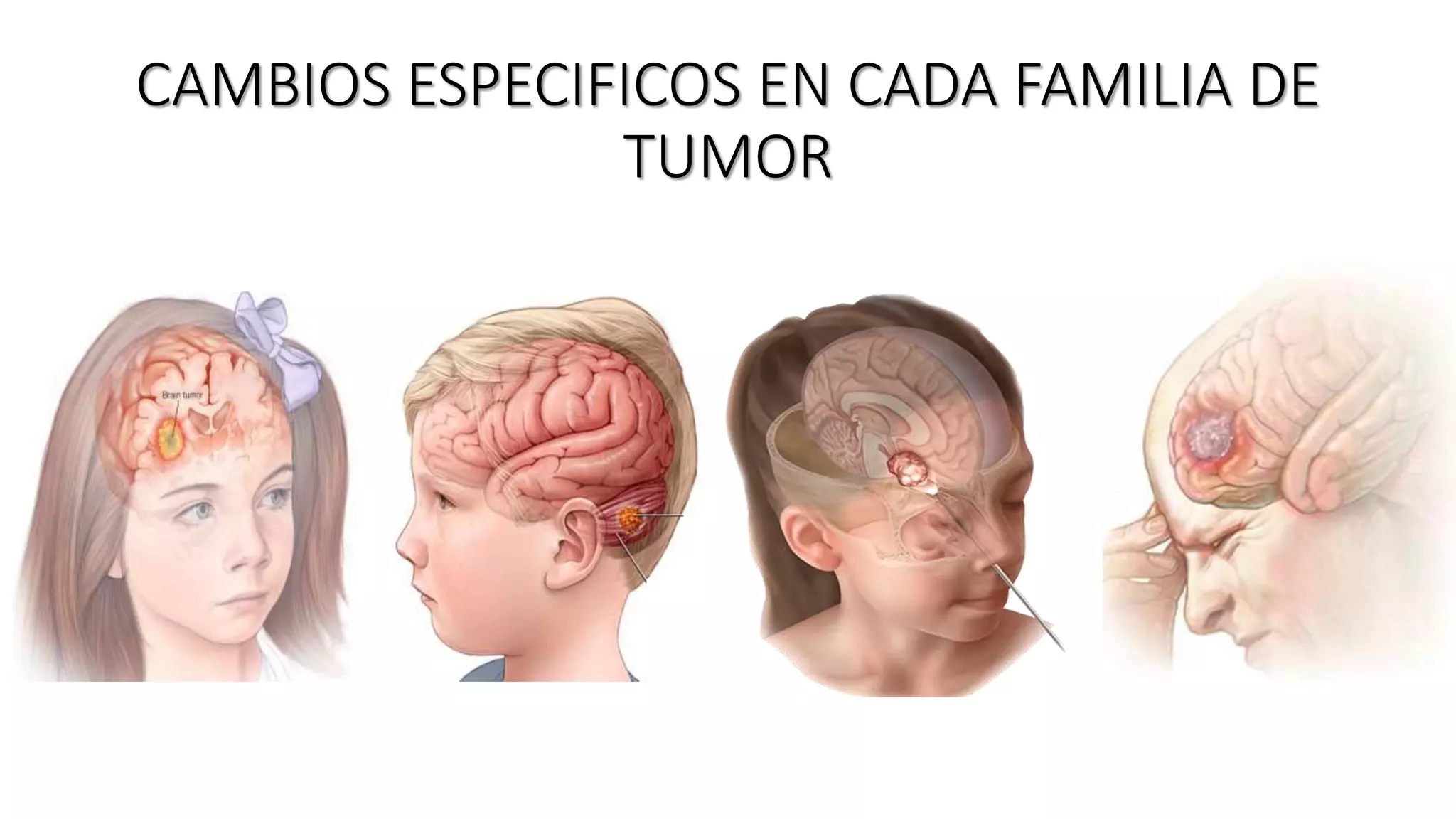 Clasificación Tumores SNC – OMS 2021.pptx