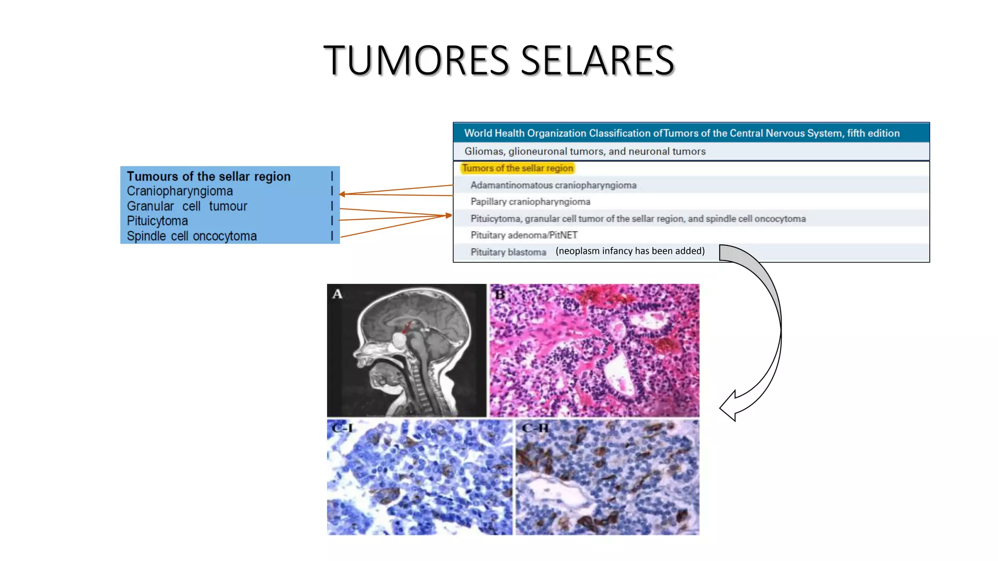 Clasificación Tumores SNC – OMS 2021.pptx