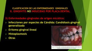 Clasificacion de las enfermedades gingivales y periodontale | PPTX