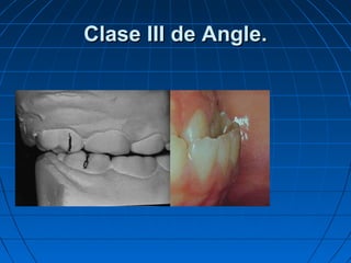 Clasificacion angle | PPT