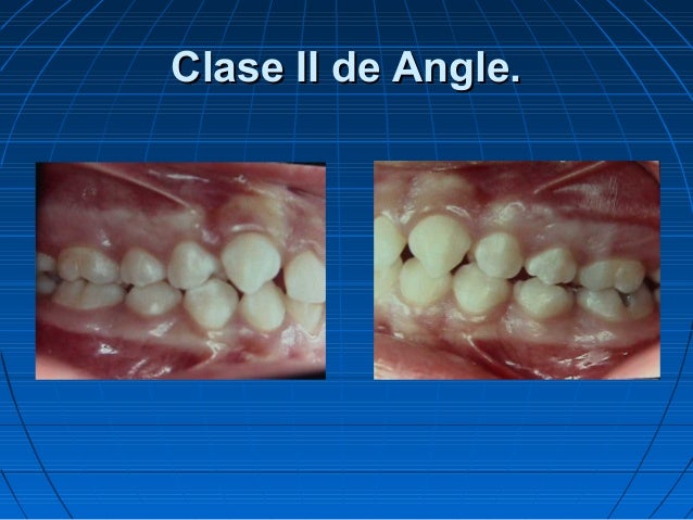 Clasificacion angle