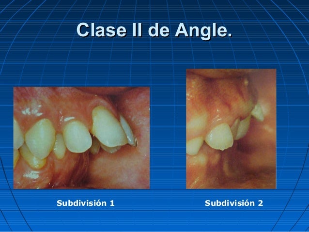 Clasificacion angle
