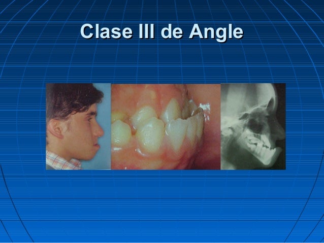 Clasificacion angle