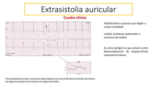 CLASIFICACION ARRITMIAS .pptx