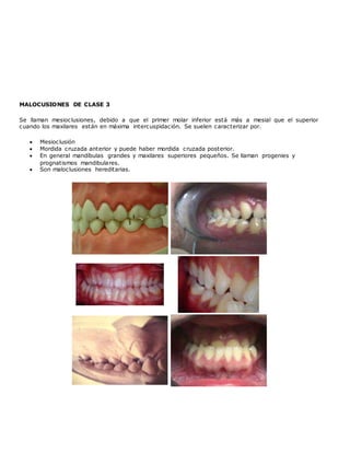 Clasificacion de angle | DOCX