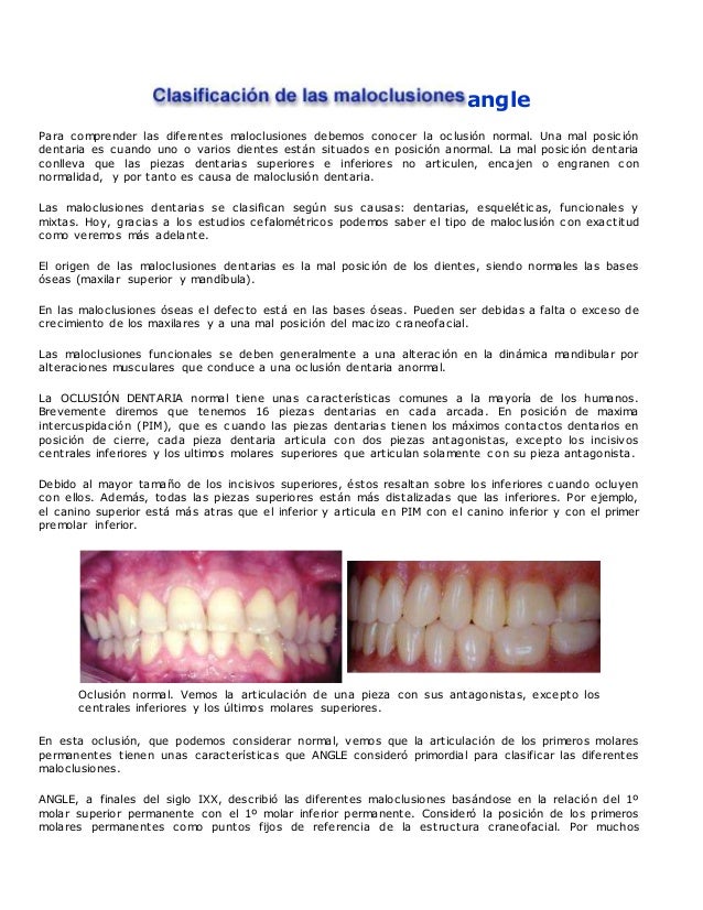 Clasificacion de angle