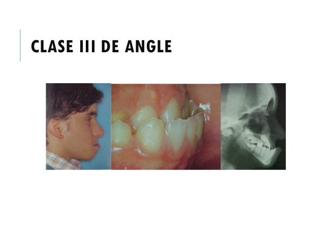 Clasificacion de anlge