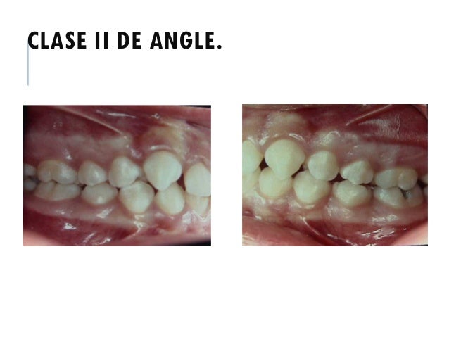Clasificacion de anlge
