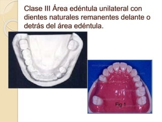 Clasificacion de arcadas parcialmente edéntulas (clasificación de ...