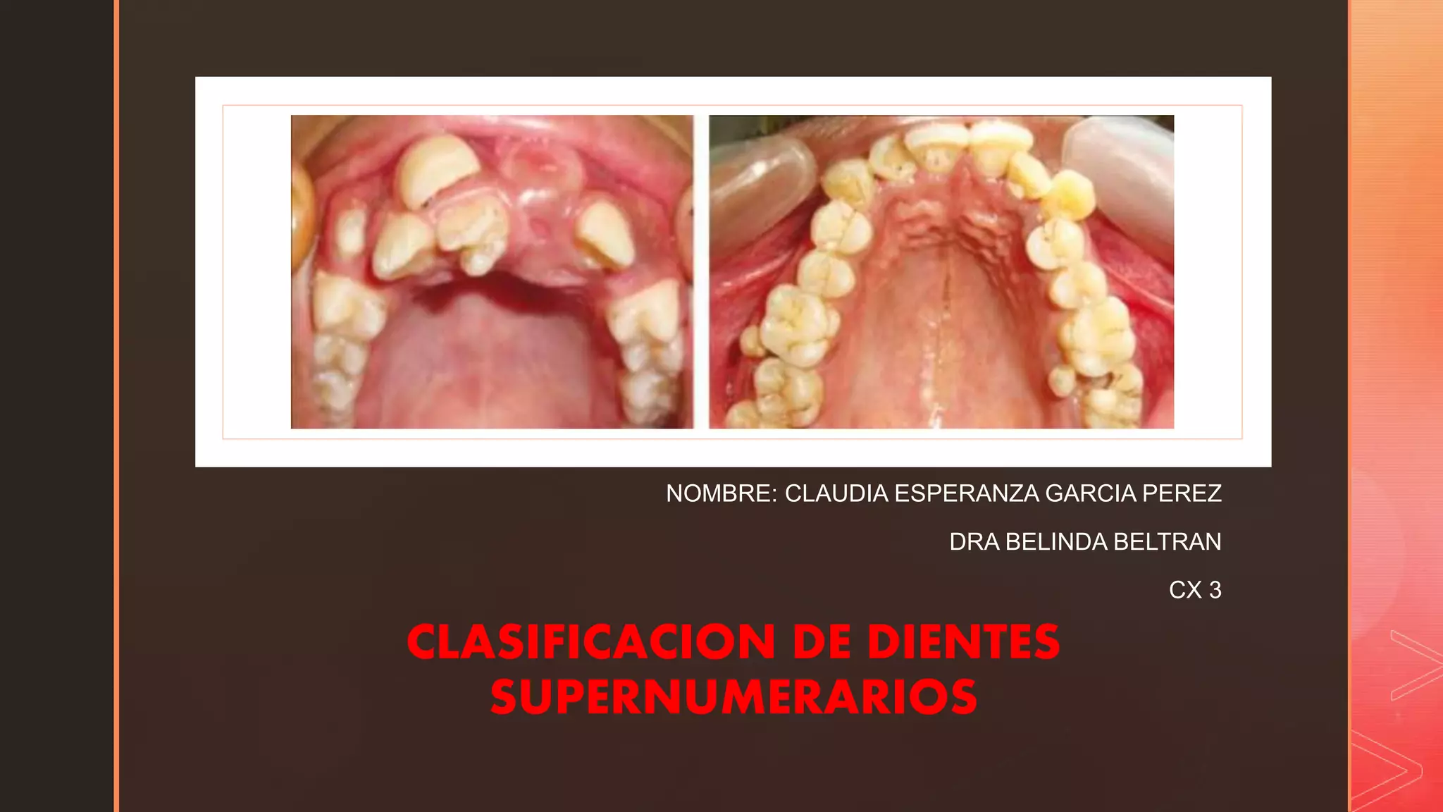 Clasificacion de dientes supernumerarios | PPTX