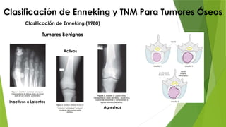 Clasificacion de Enneking en patologias. | PPTX