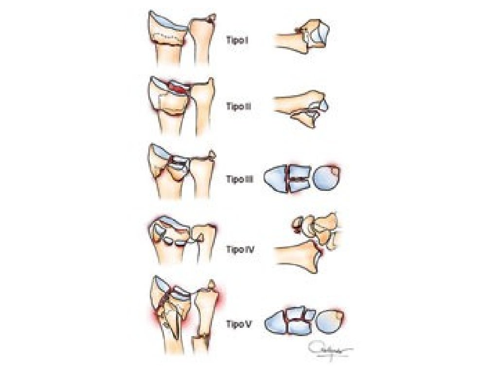 Clasificacion de fernandez para fracturas distales de radio