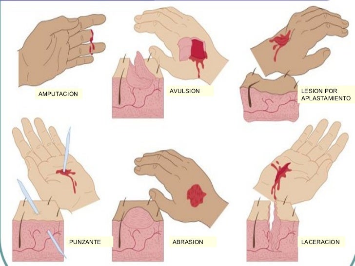 Clasificacion de heridas