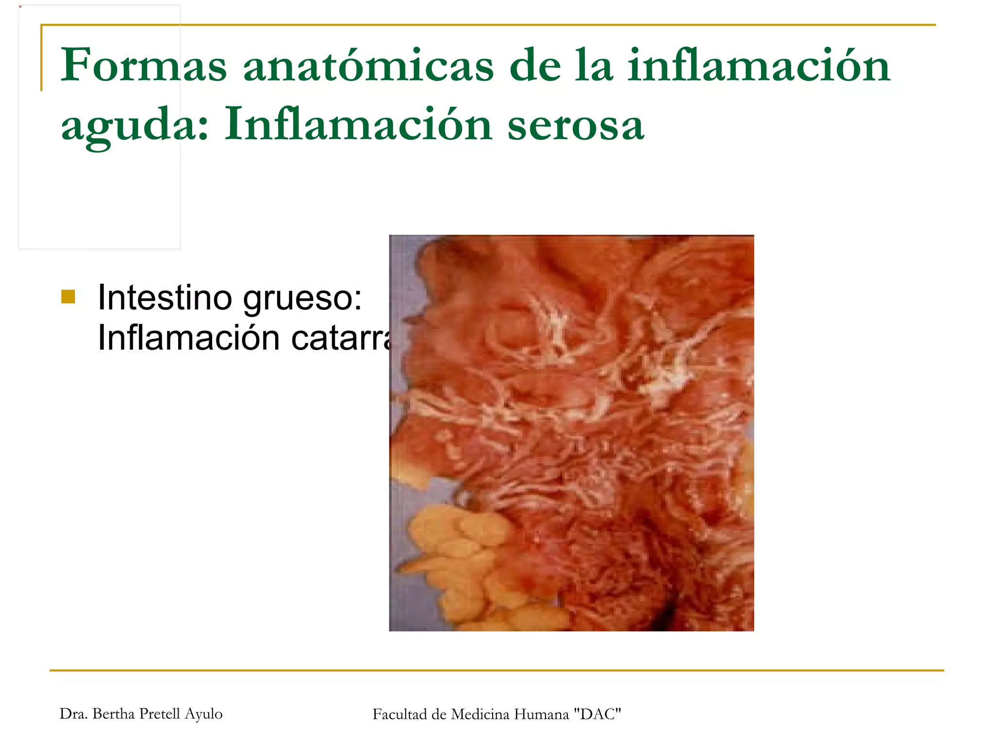 Clasificacion de la_inflamacion | PPT