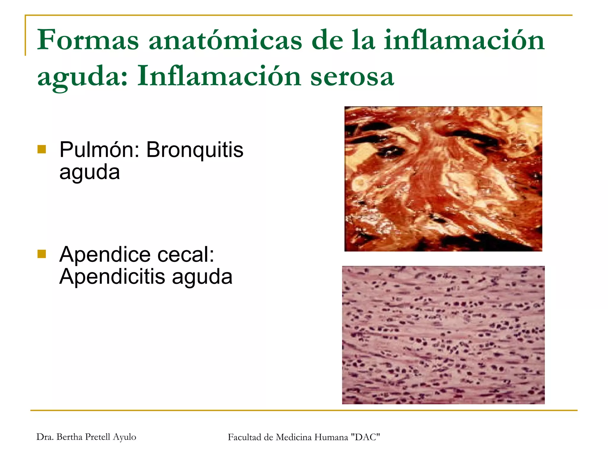 Clasificacion de la_inflamacion | PPT
