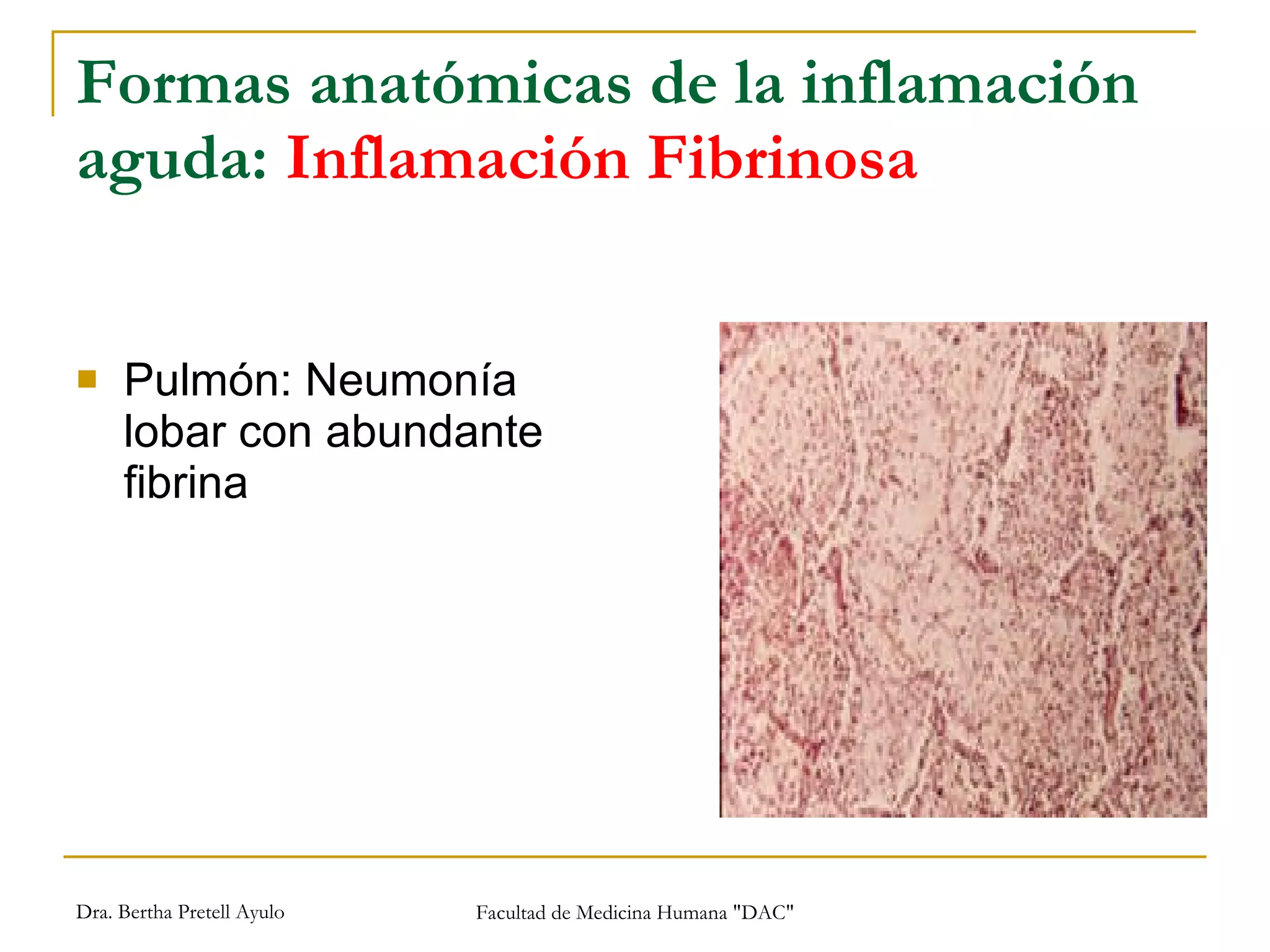Clasificacion de la_inflamacion | PPT