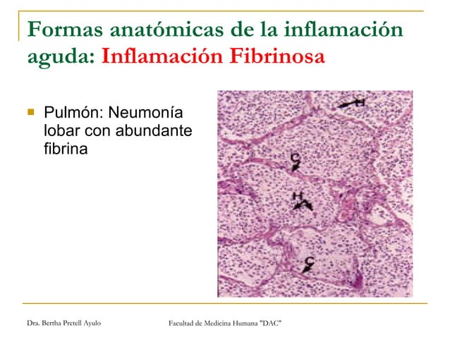 Clasificacion de la_inflamacion | PPT