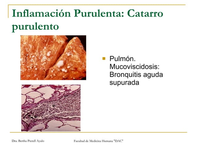 Clasificacion de la_inflamacion | PPT