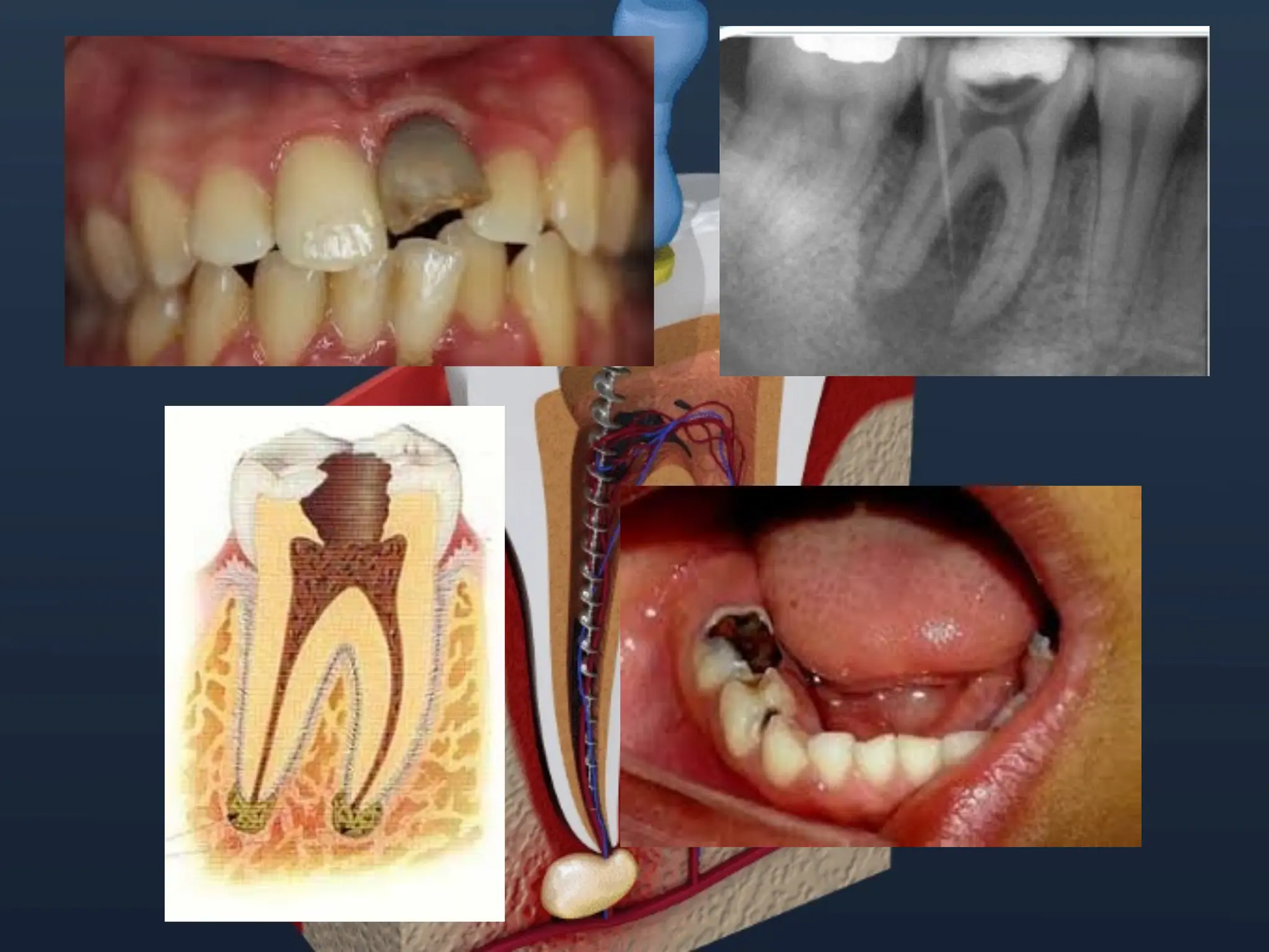 Clasificación de la patología pulpar y periapical según la AAE (1).pdf