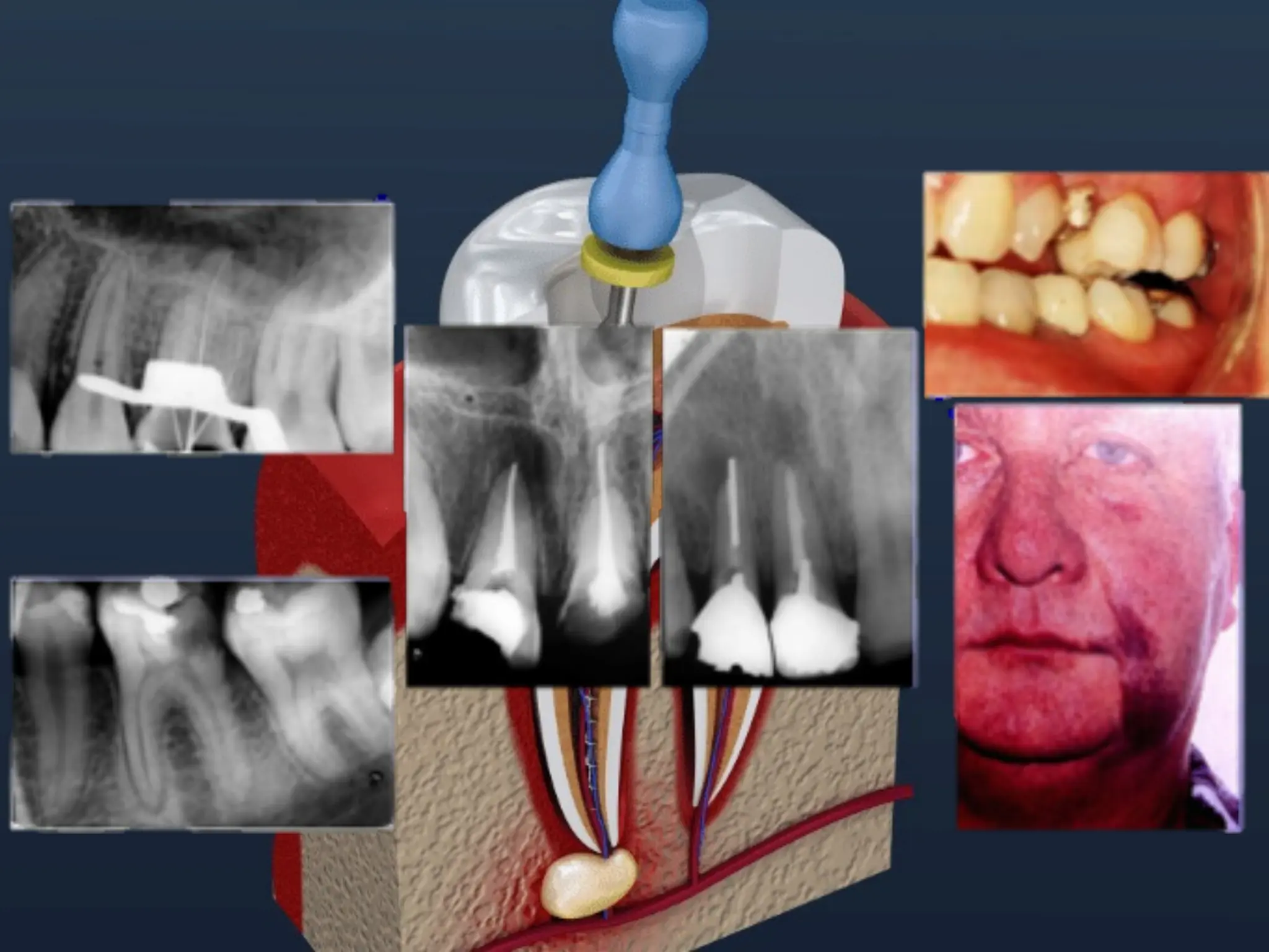 Clasificación de la patología pulpar y periapical según la AAE (1).pdf