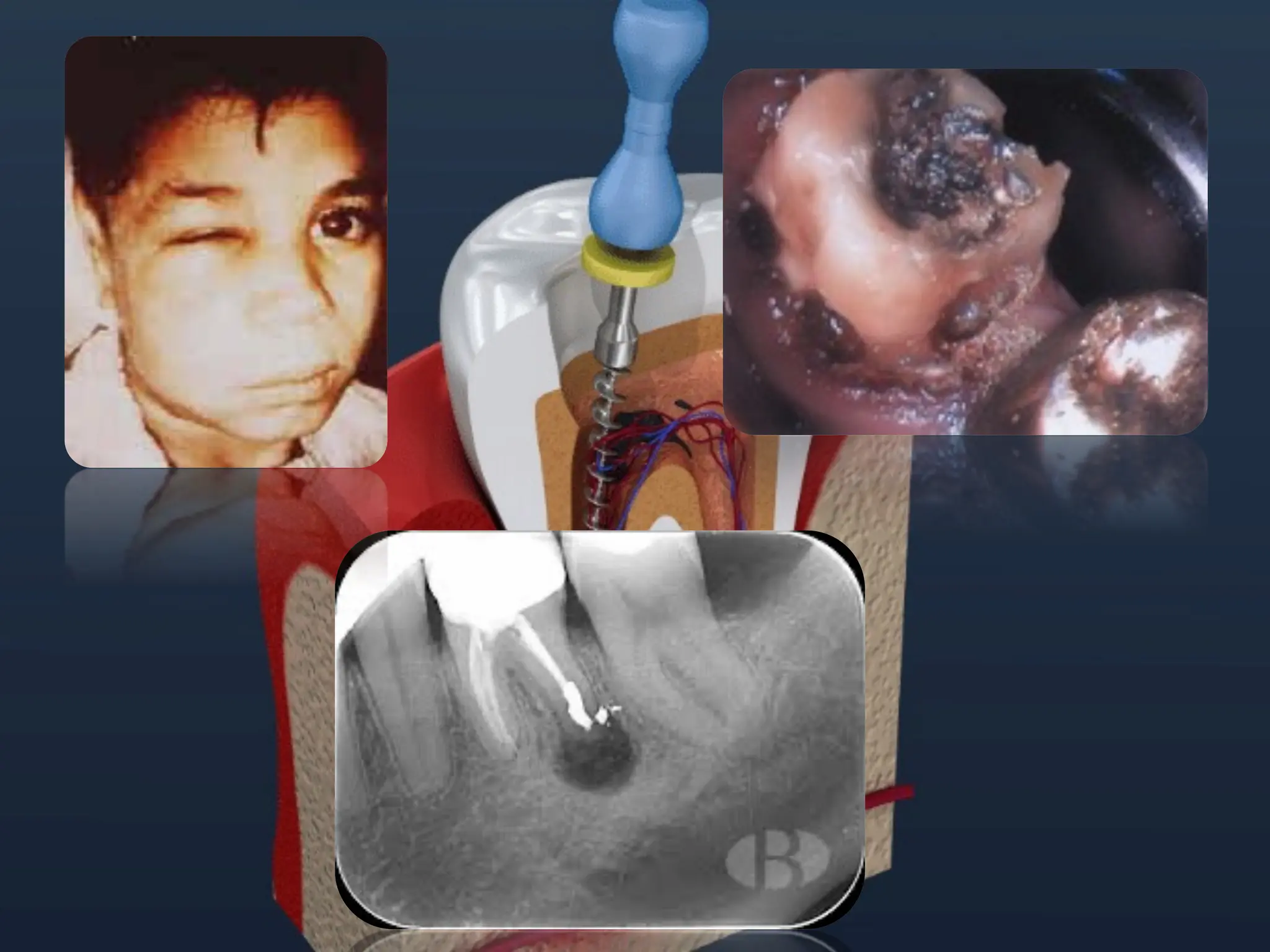 Clasificación de la patología pulpar y periapical según la AAE (1).pdf