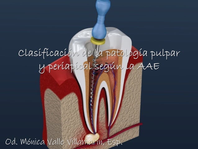 Clasificación de la patología pulpar y periapical según la AAE (1).pdf