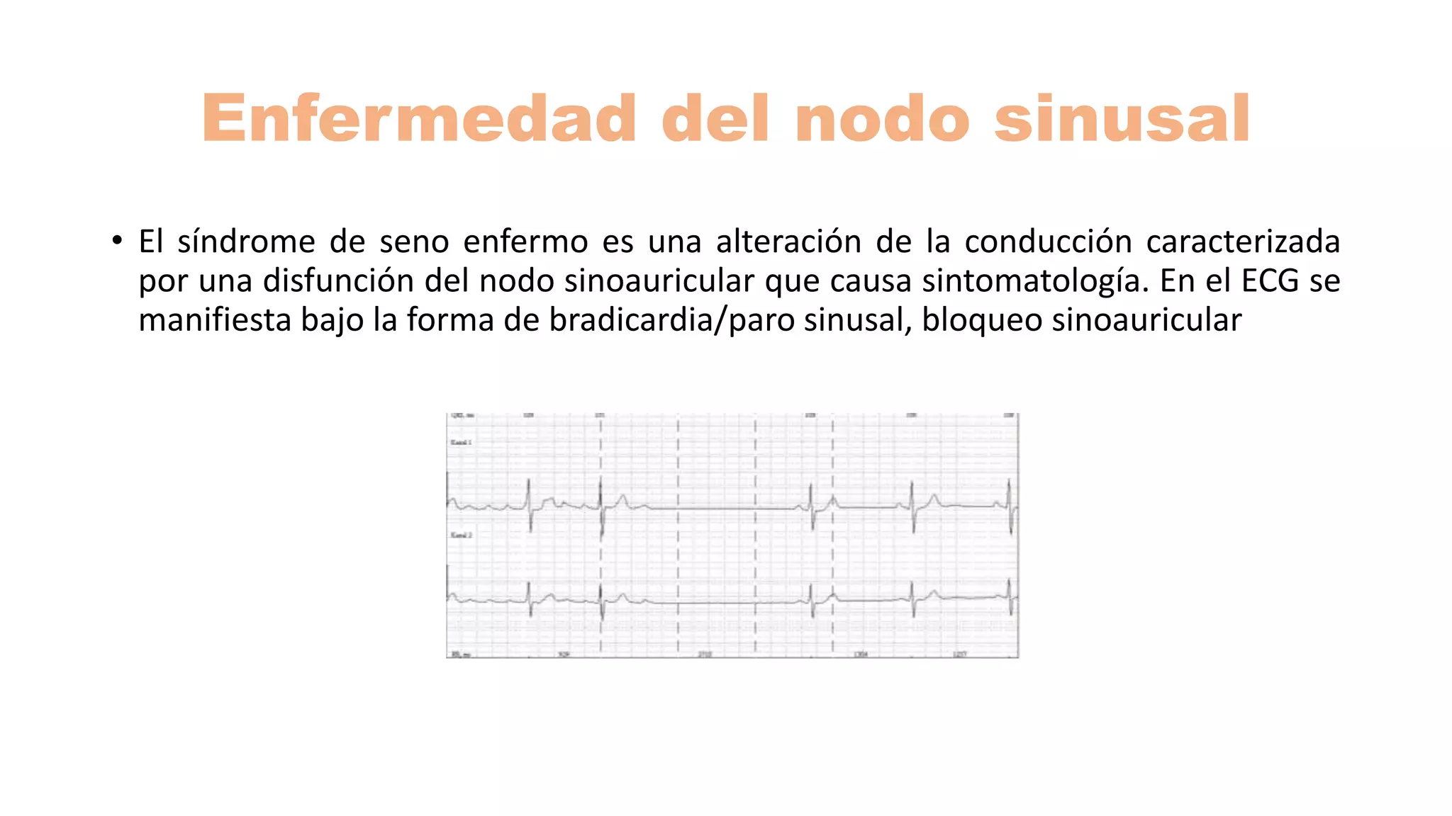Clasificacion de las arritmias | PPTX