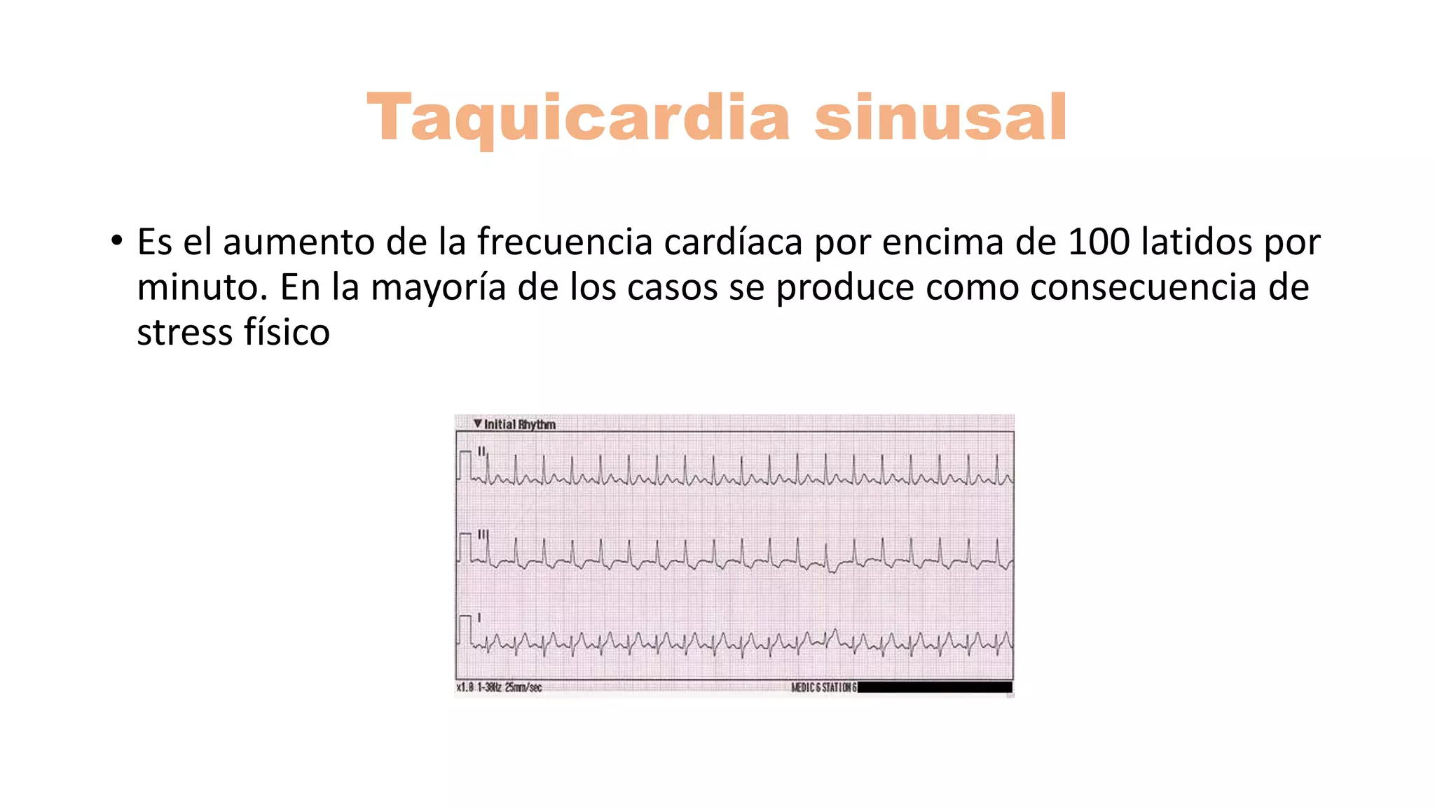 Clasificacion de las arritmias | PPTX