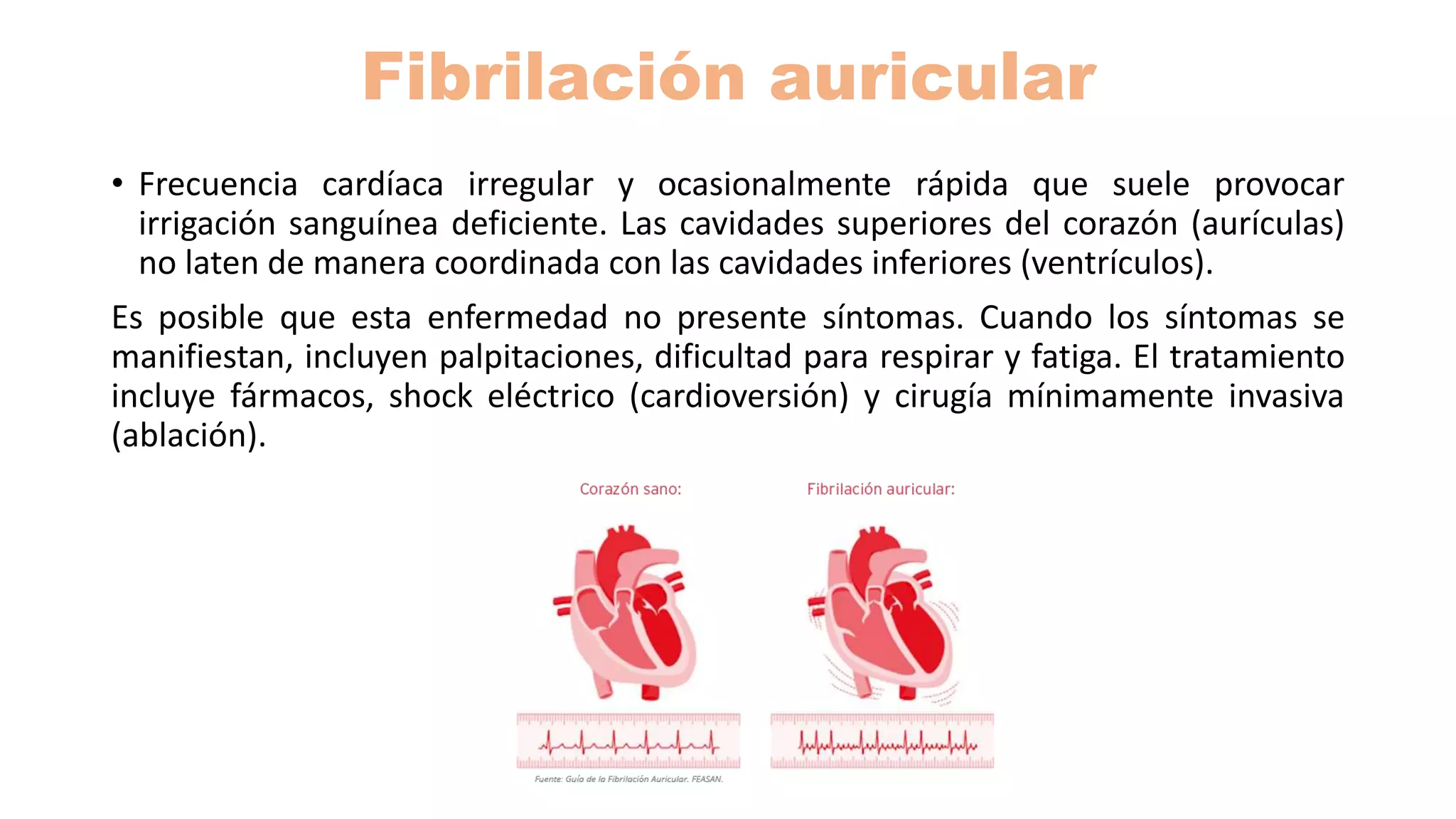 Clasificacion de las arritmias | PPTX