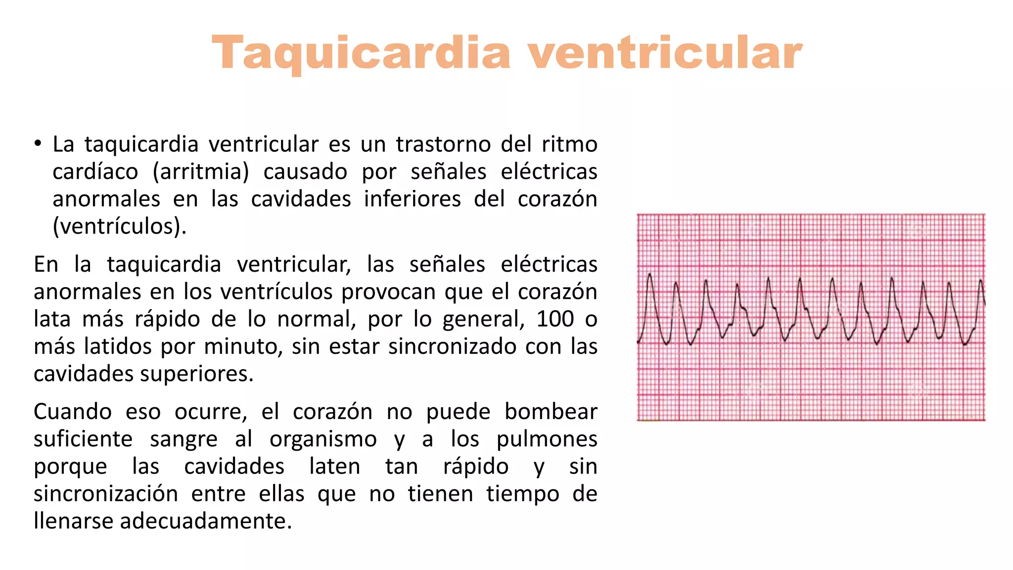 Clasificacion de las arritmias | PPTX