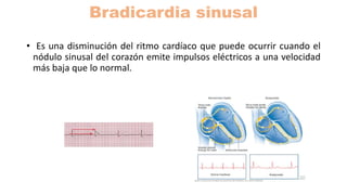 Clasificacion de las arritmias | PPTX