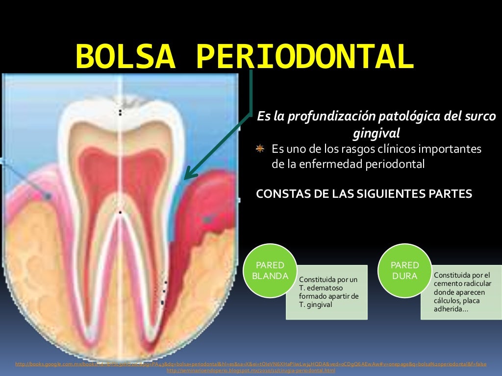 O Que é Bolsa Periodontal - RETOEDU