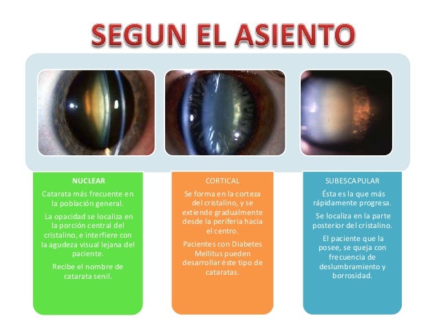 Clasificacion de las cataratas
