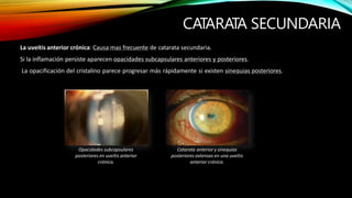 CLASIFICACION DE LAS CATARATAS.pptx